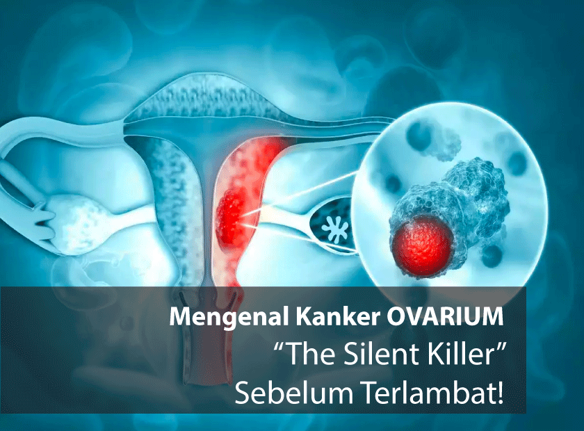 Mengenal Kanker Ovarium “The Silent Killer” Sebelum Terlambat!